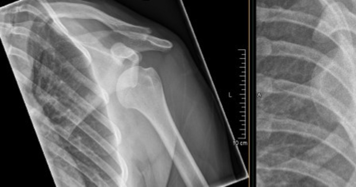 Schulterluxation beim Handball – wenn die Schulter aus dem Gelenk ...